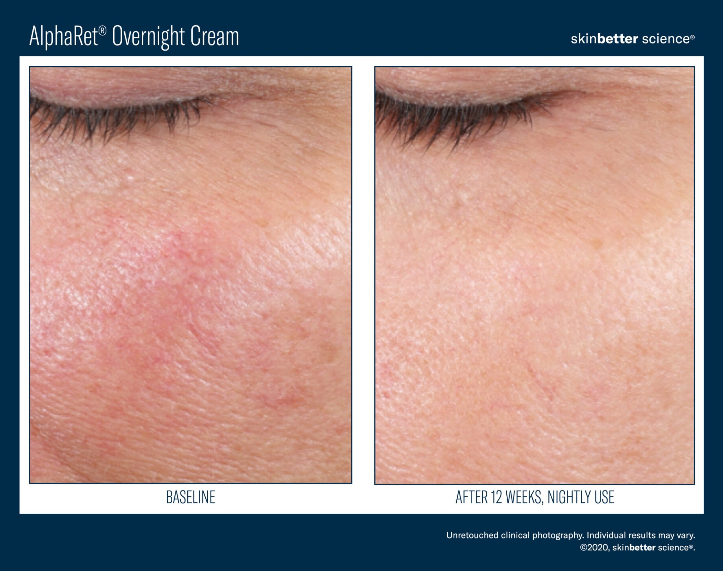 Skinbetter AlphaRet Overnight Cream 1.7 fl oz is On Sale!