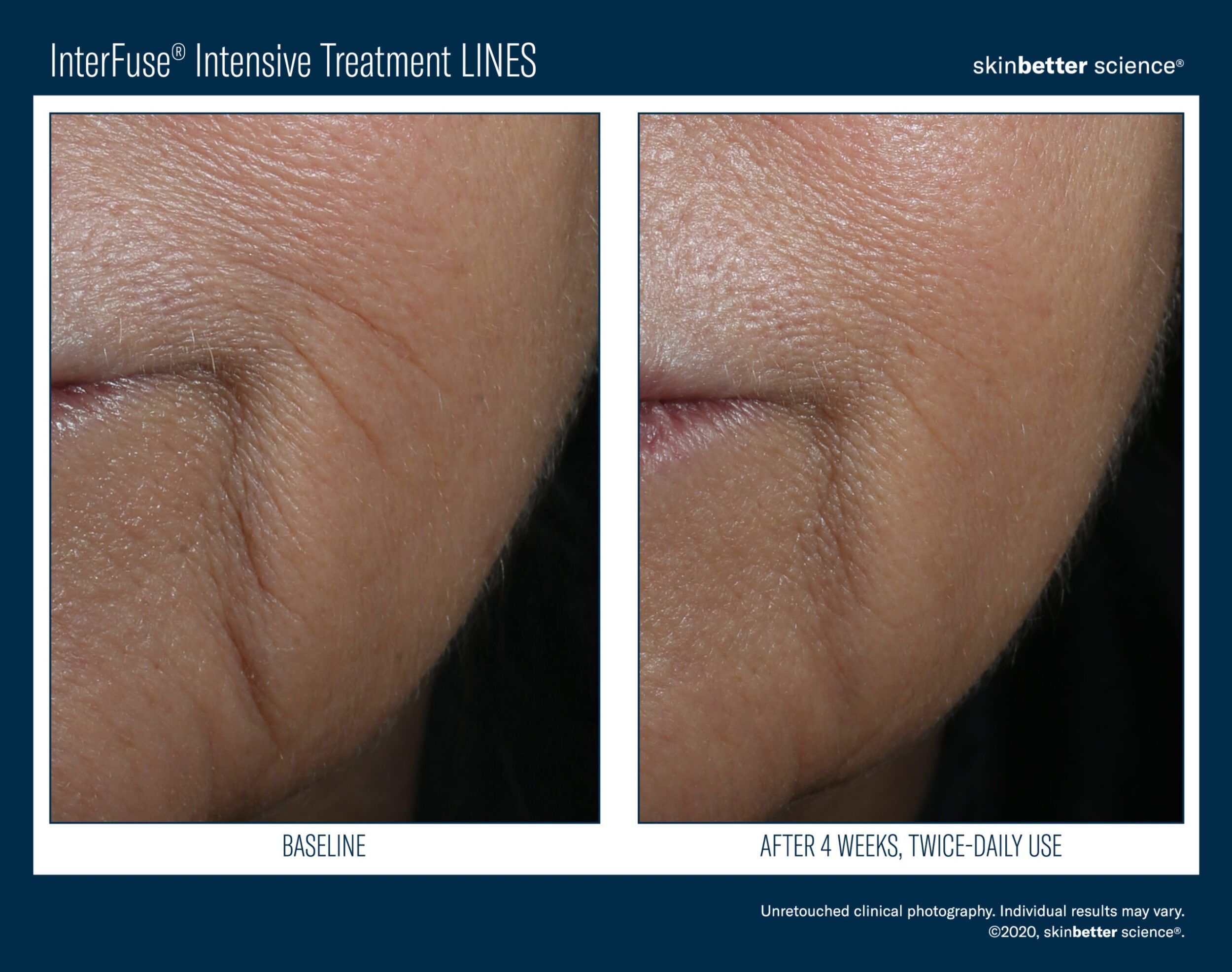 Skinbetter InterFuse Intensive Treatment LINES is On Sale!