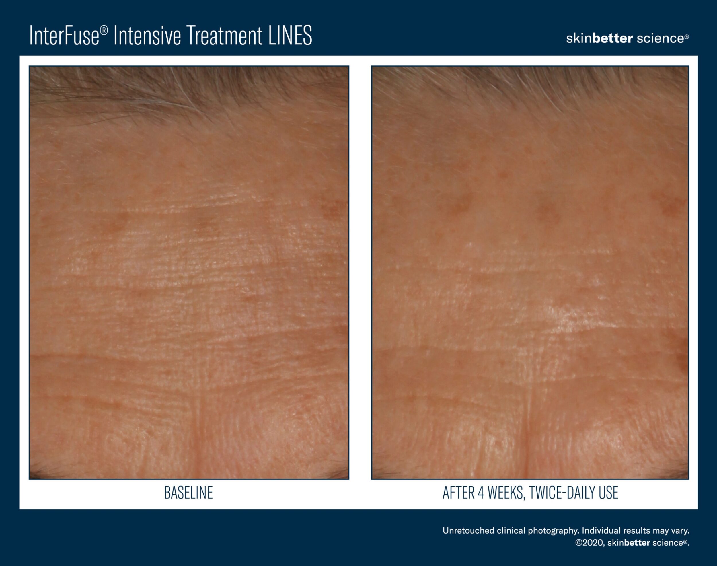 Skinbetter InterFuse Intensive Treatment LINES is On Sale!